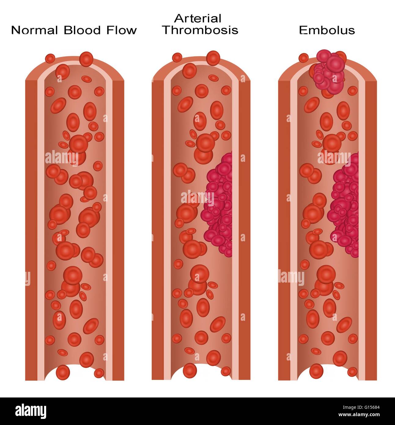 Arterial thrombosis Banque d'images détourées - Alamy