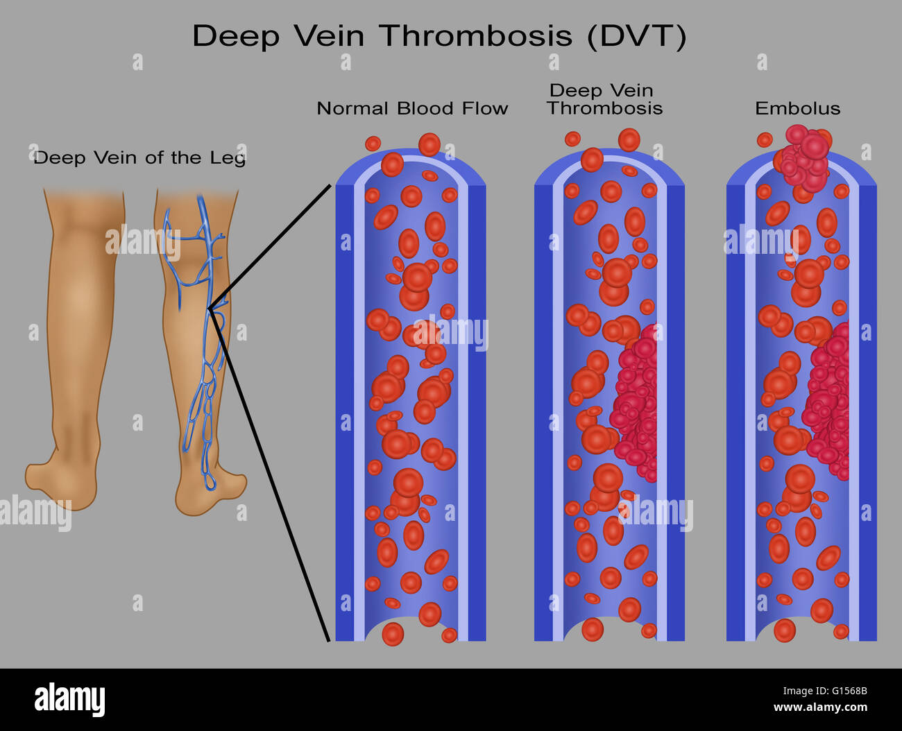 Thrombose veineuse profonde Banque de photographies et d’images à haute ...