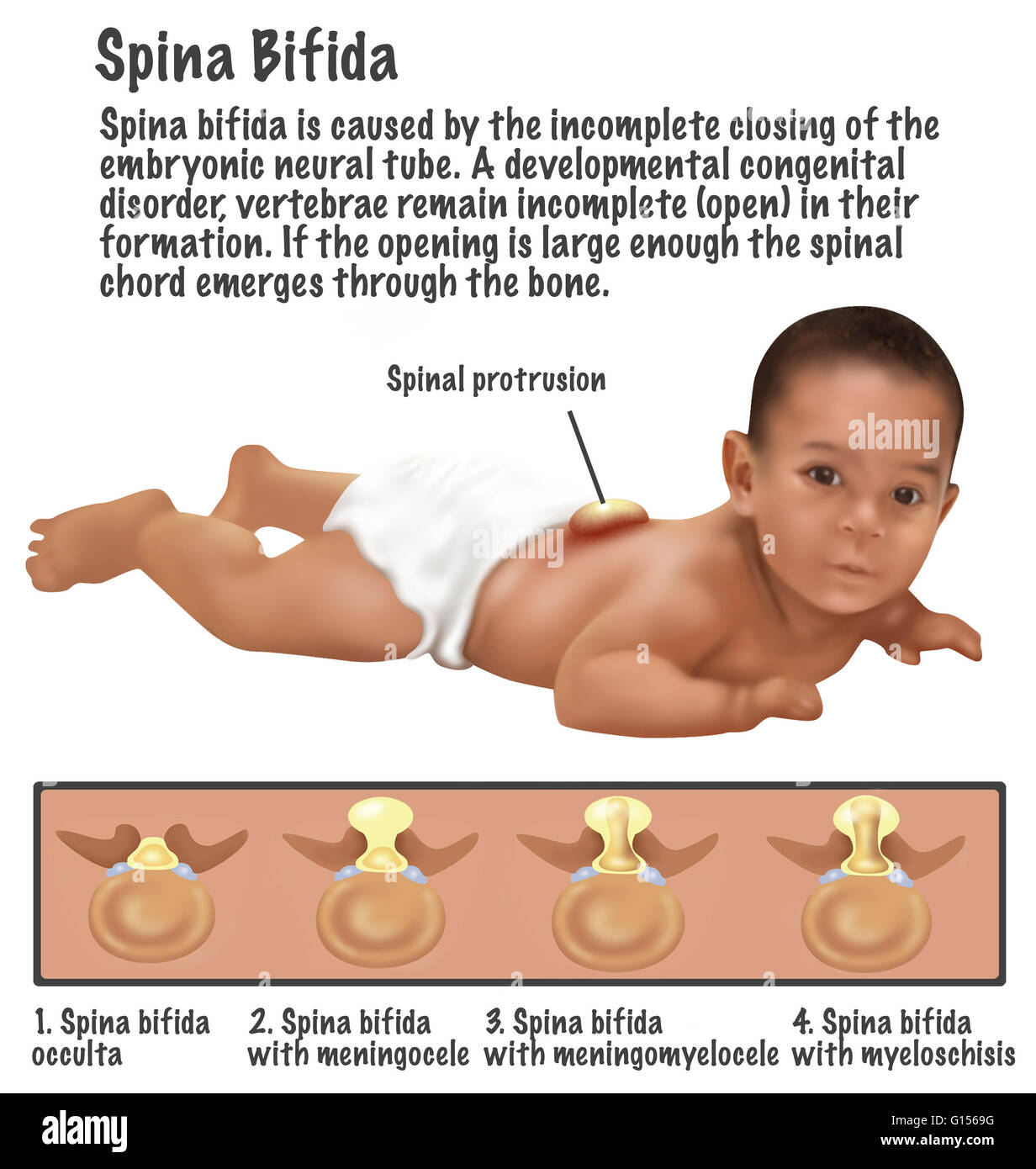 Spina Bifida Photos And Spina Bifida Images Alamy