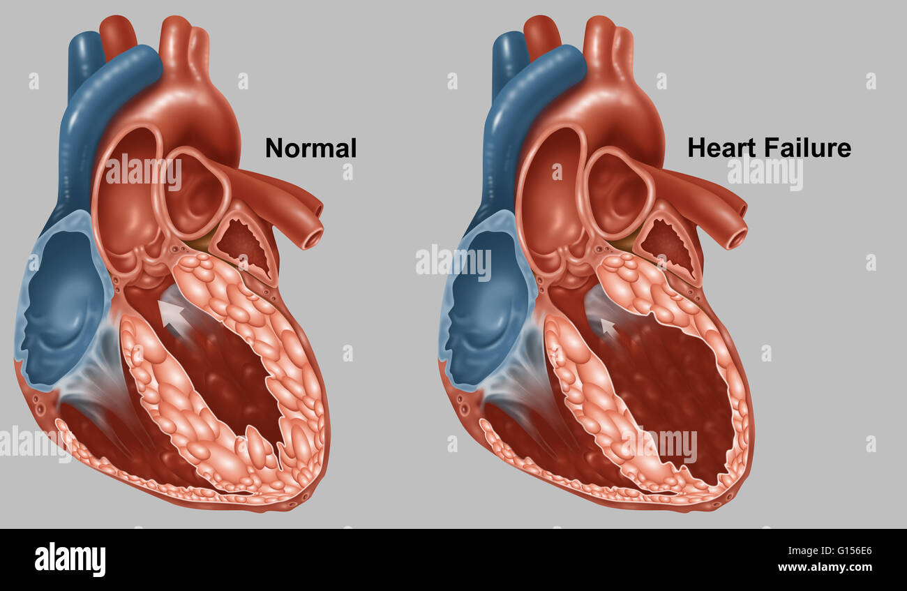 Comparer une illustration de chaleur normale (à gauche) pour un coeur ...