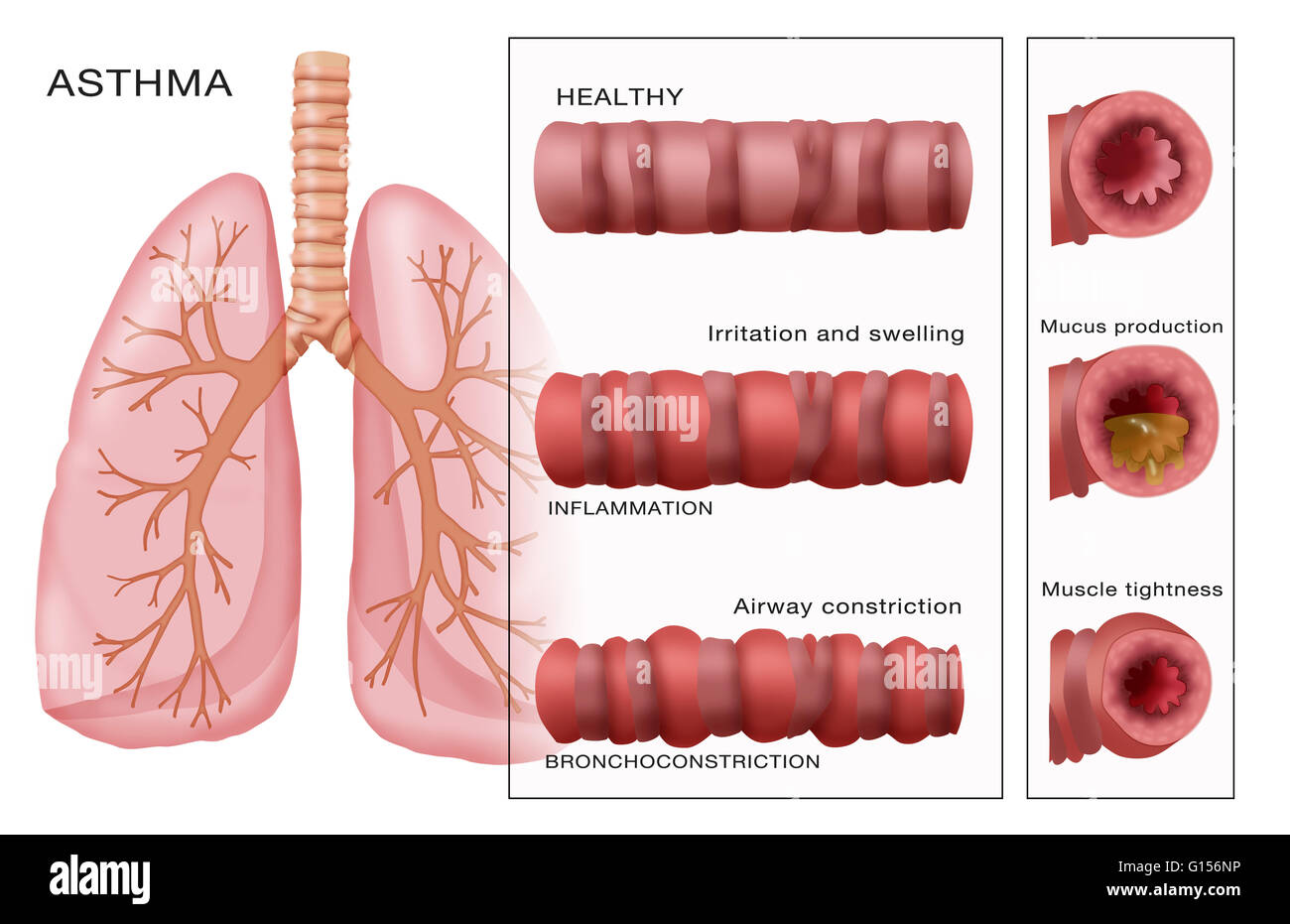 Illustration montrant le développement de constriction bronchioles ...