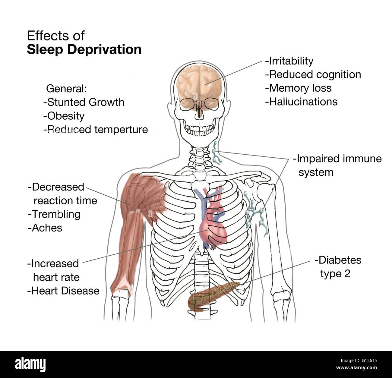 Effets de privation de sommeil Banque de photographies et d’images à ...