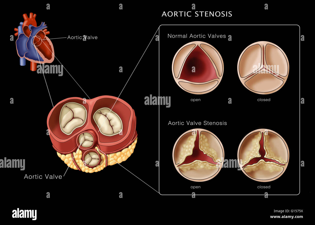 Illustration de valves aortiques normale par rapport à une sténose ...