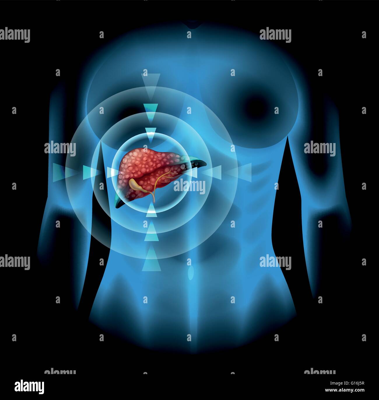 La sclérose en plaques dans le corps humain illustration Image ...
