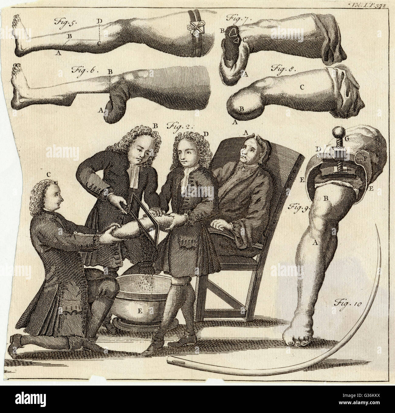 Leg Amputation Banque d'image et photos - Alamy