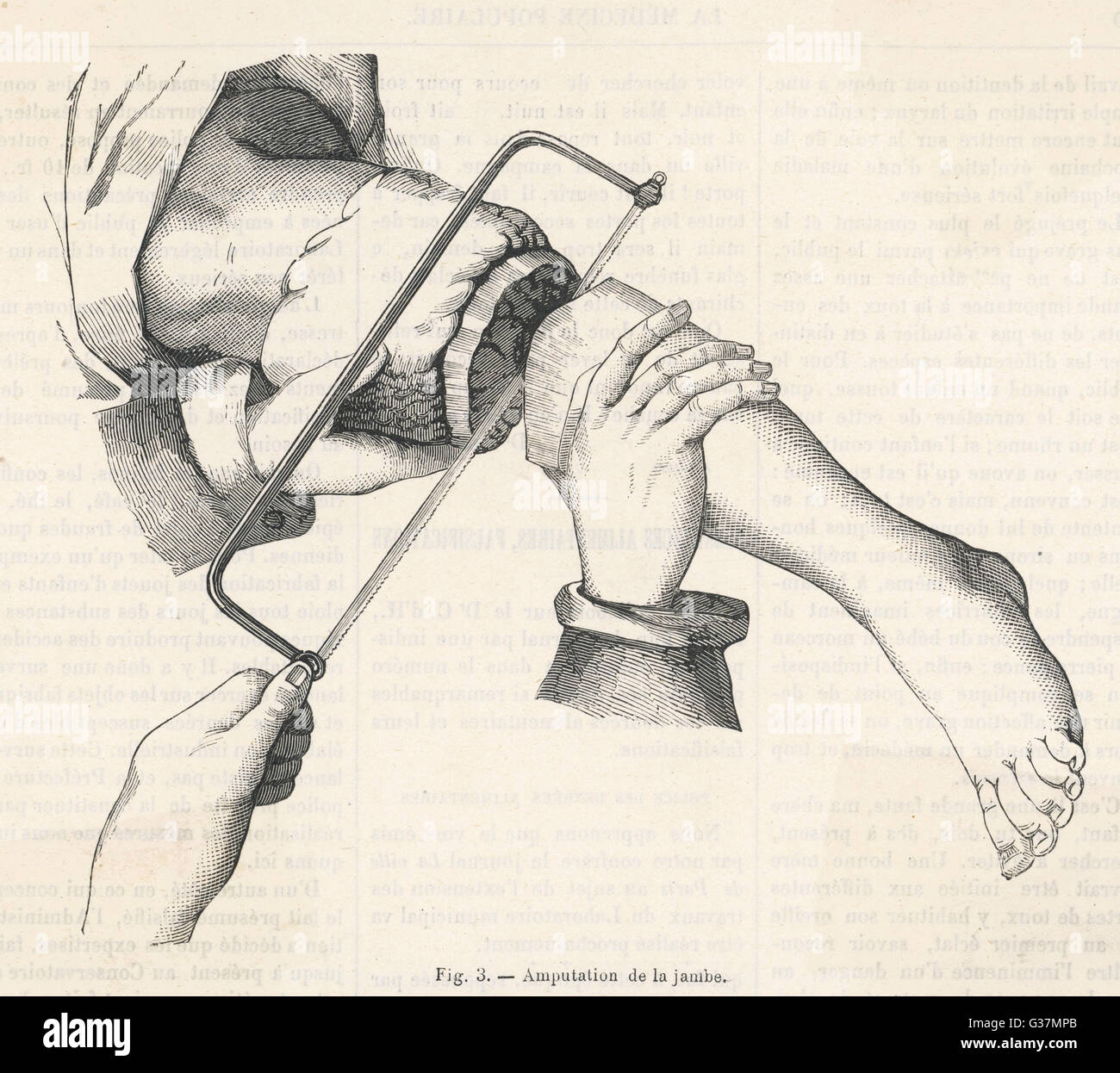 Amputation d'une jambe Banque de photographies et d’images à haute ...
