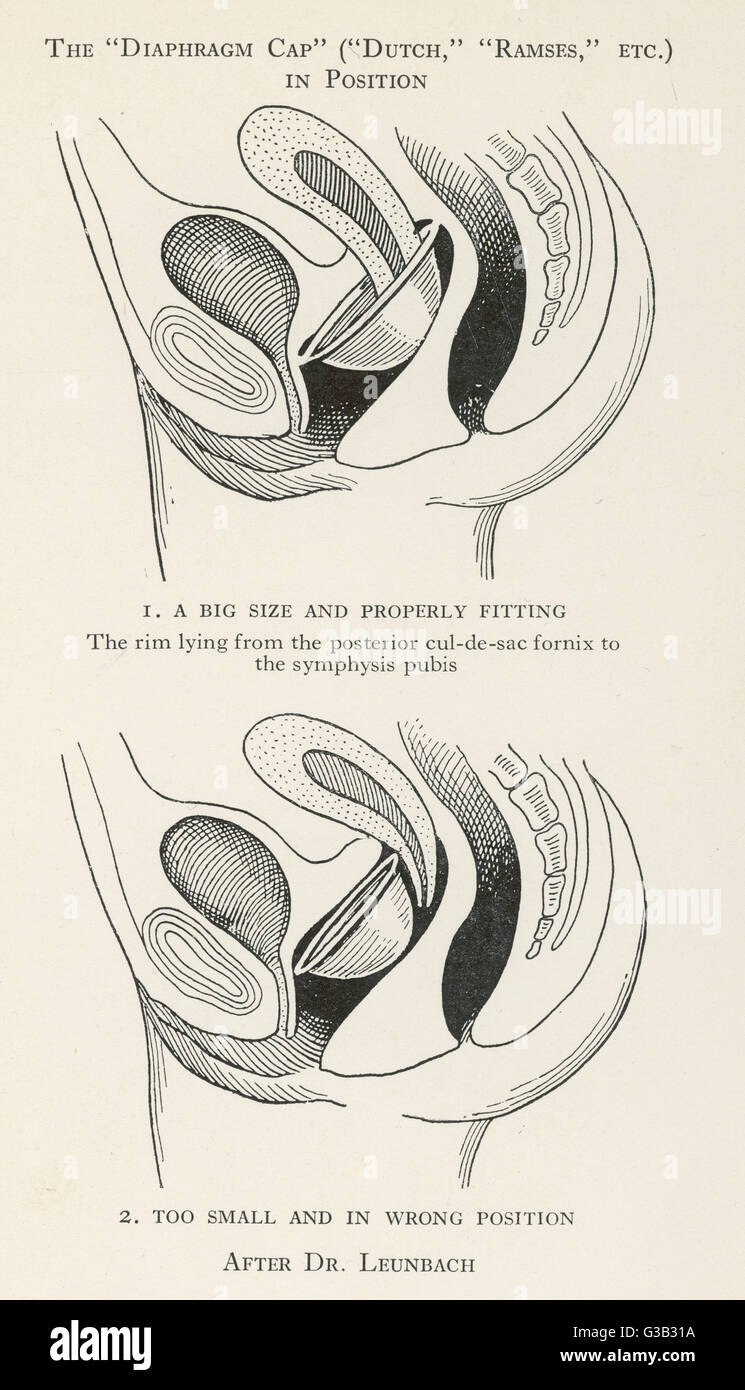 Contraception diaphragm Banque de photographies et d’images à haute ...