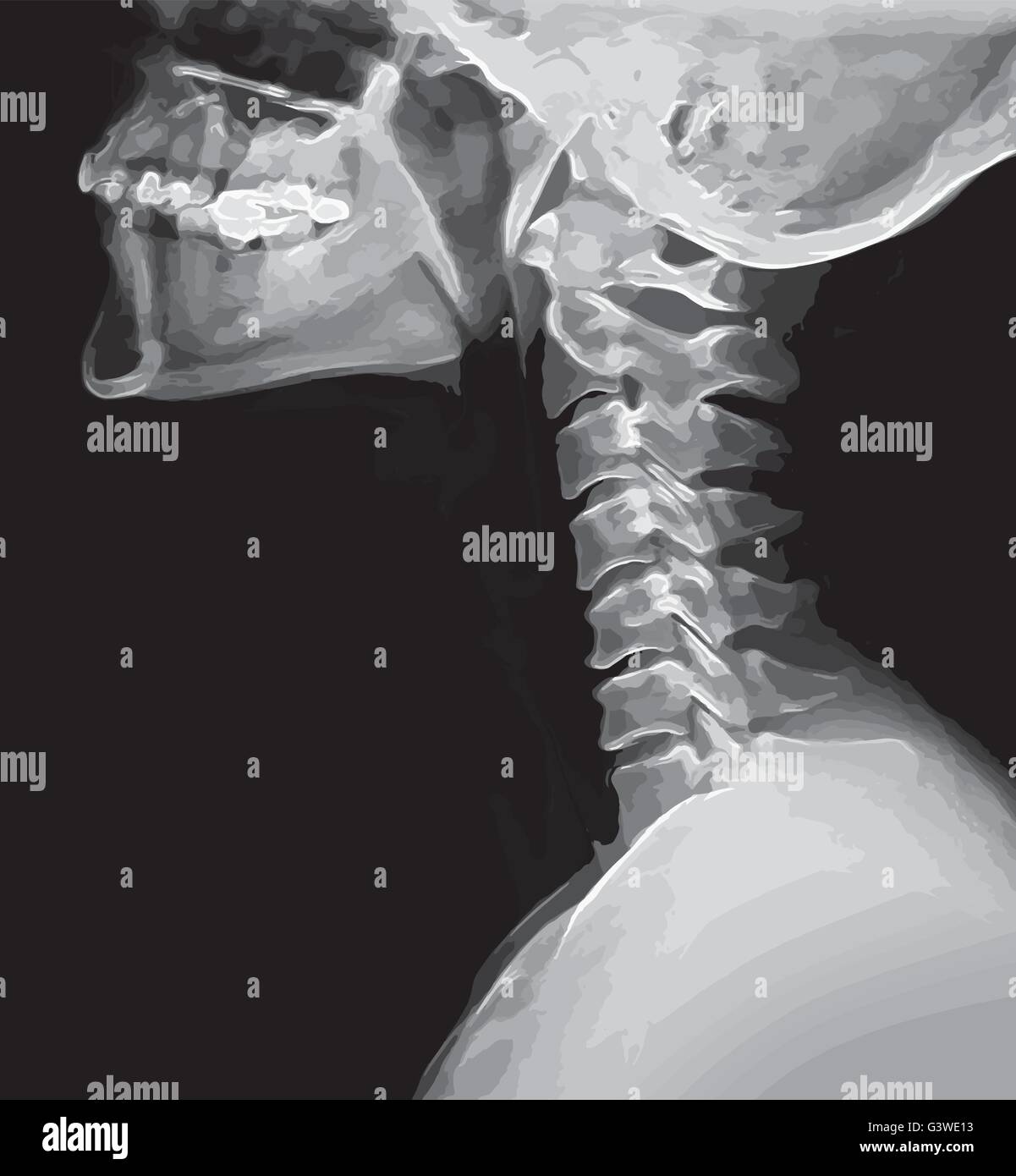 Radiographie cervicale des vertèbres cervicales Banque d'images ...