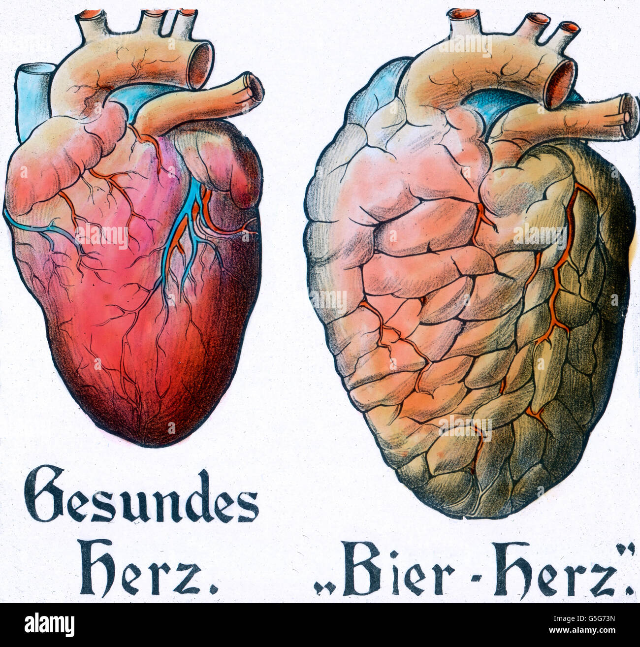 Der Unterschied zwischen einem gesunden und einem Trinker-Herz. Un ...