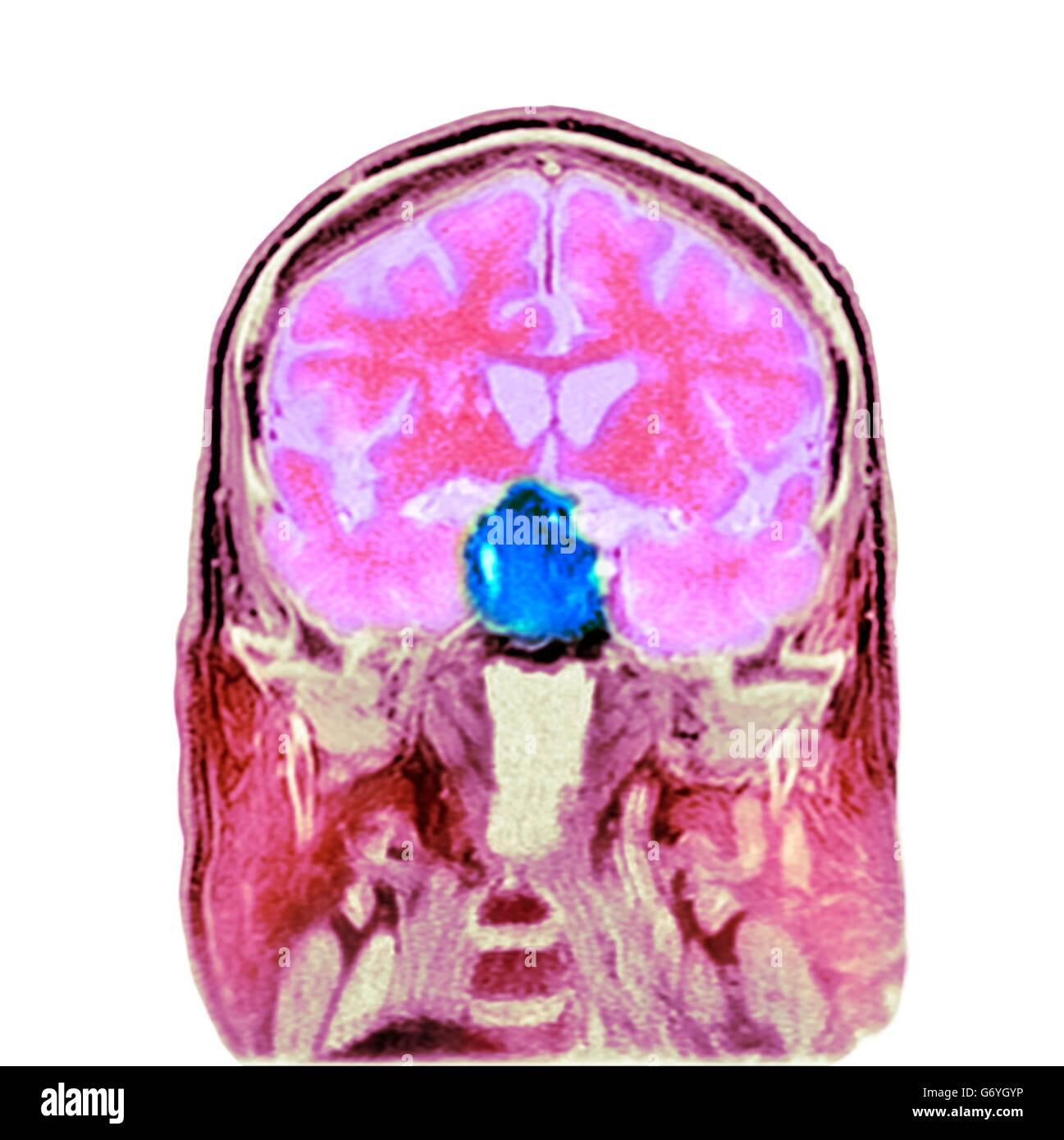 Tumeur de l'hypophyse. La tomographie de couleur (CT) d'une section à ...