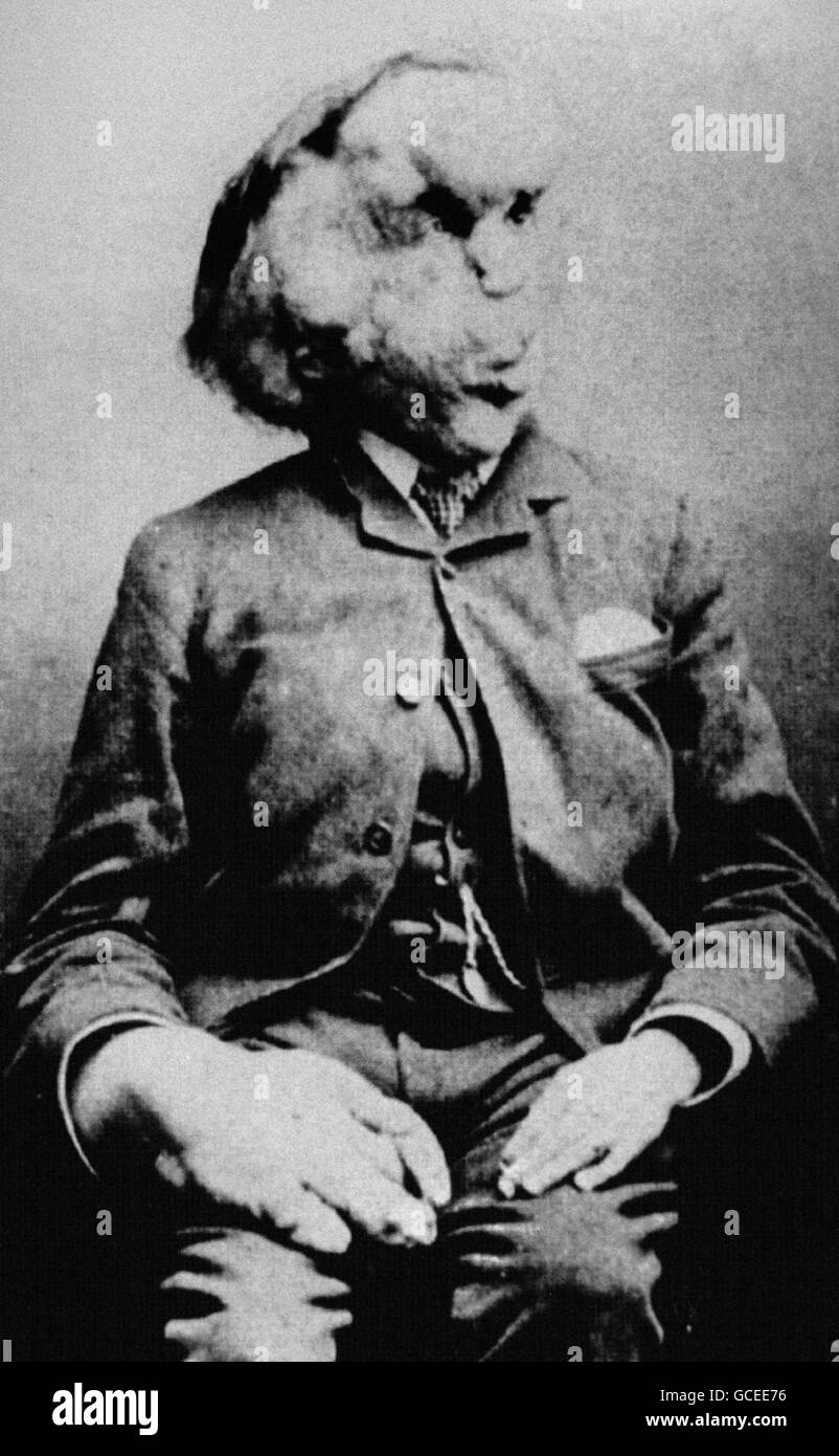 Joseph merrick elephant man Banque de photographies et d’images à haute ...