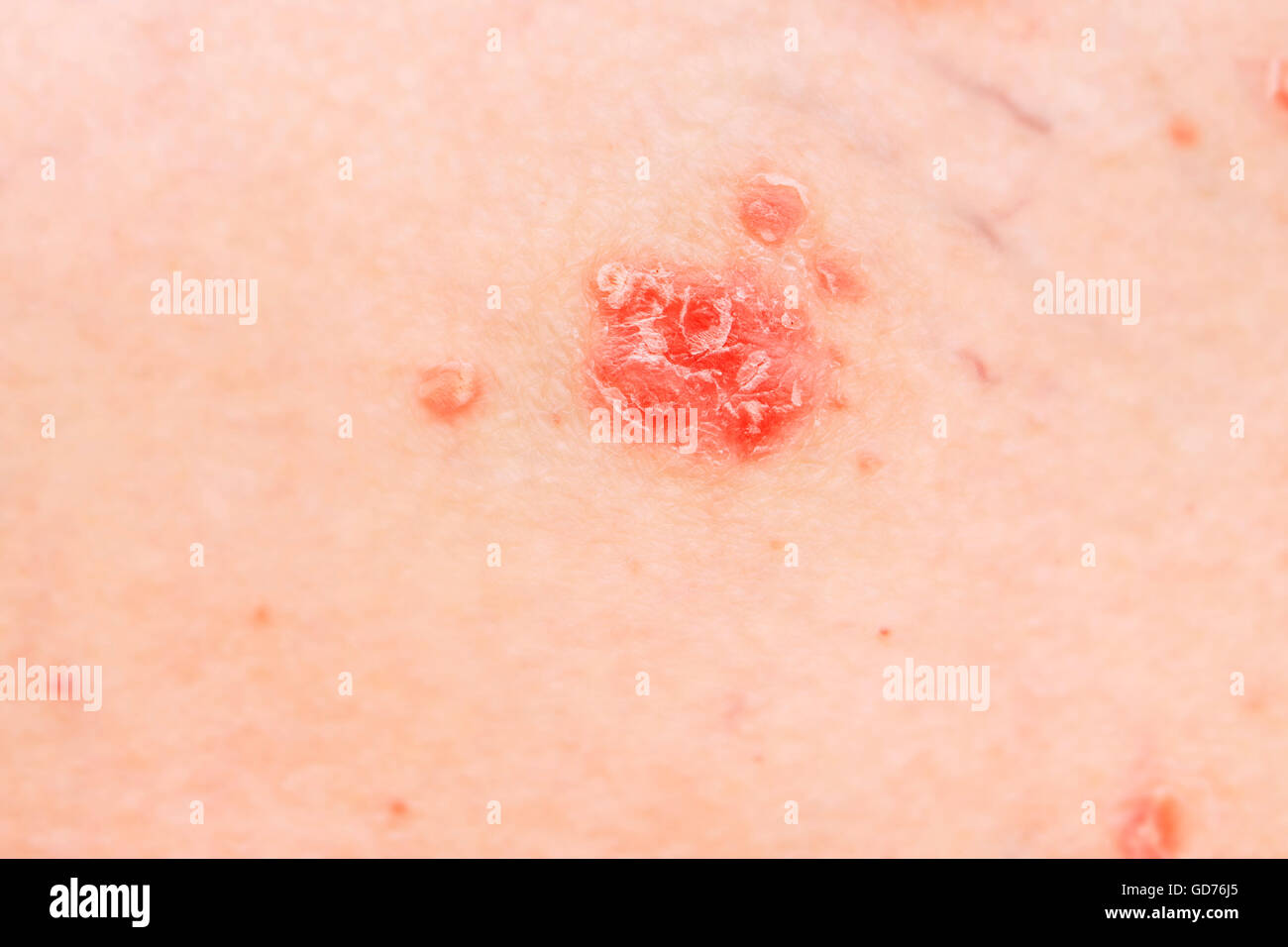 Psoriasis Vulgaris Banque d'image et photos - Alamy