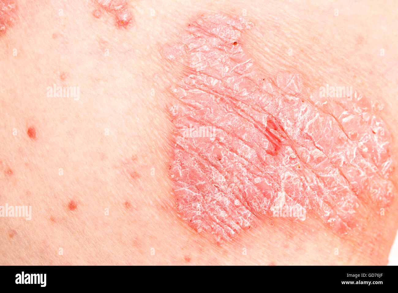 Psoriasis Vulgaris Banque d'image et photos - Alamy