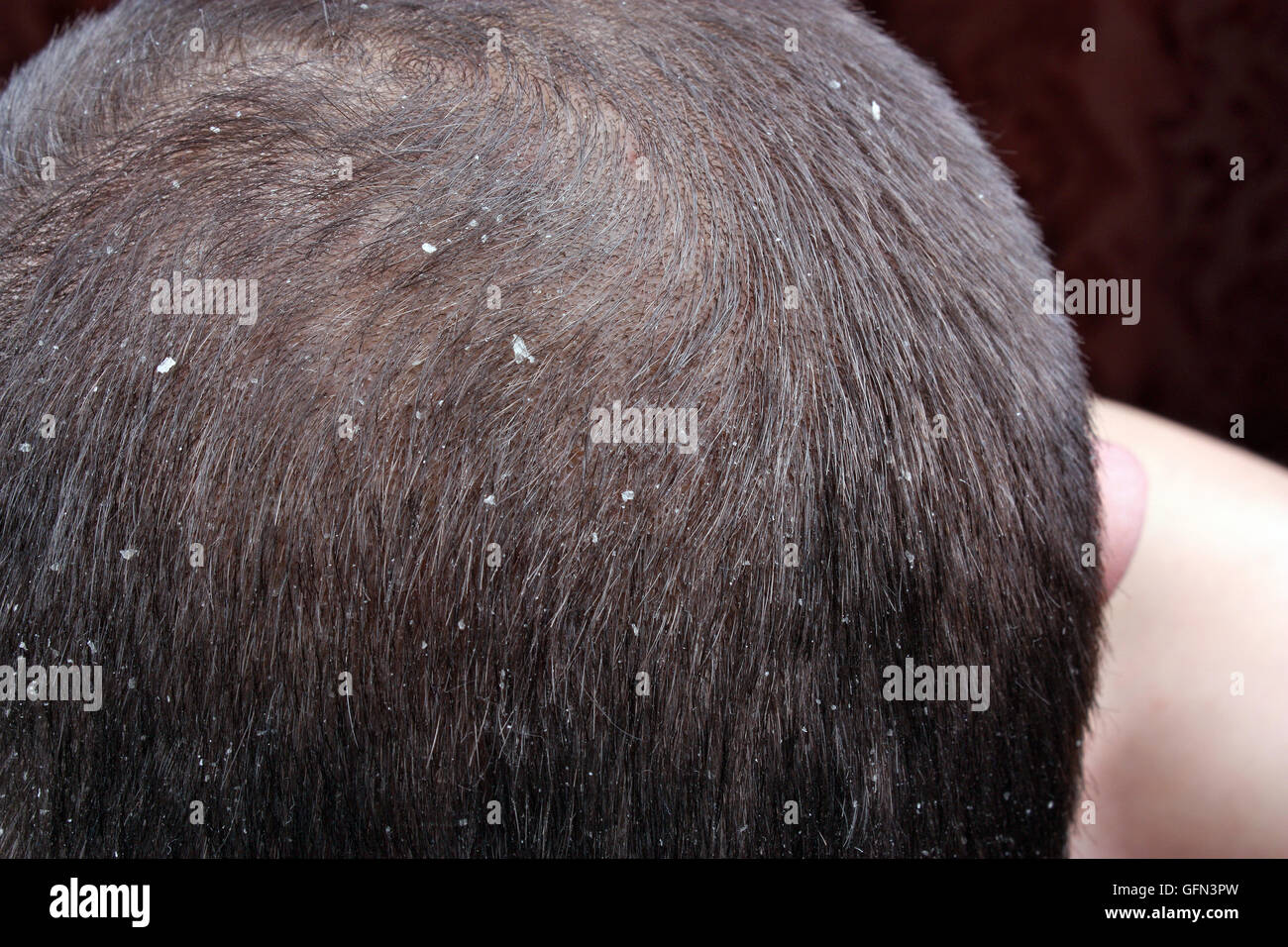 Maladie de peau chez les hommes Banque de photographies et d’images à ...