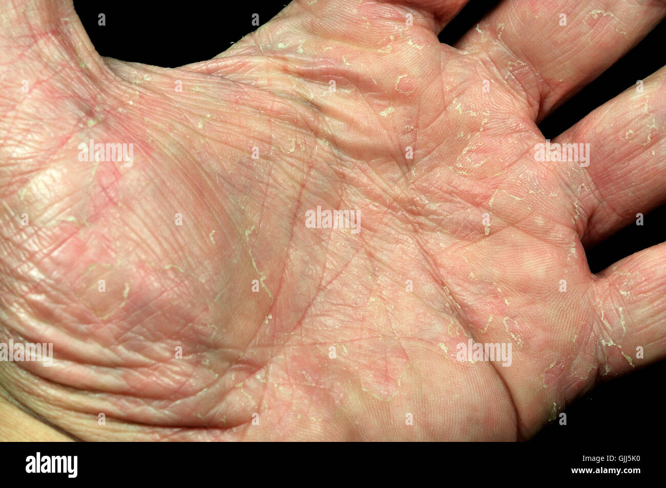 Maladie de peau de la main Banque de photographies et d’images à haute ...
