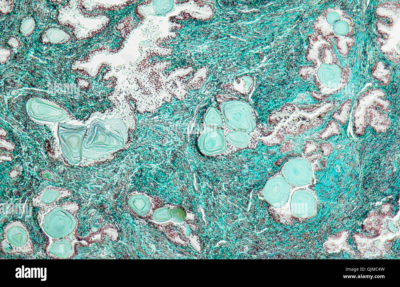 Prostatasteinchen Banque de photographies et d’images à haute ...