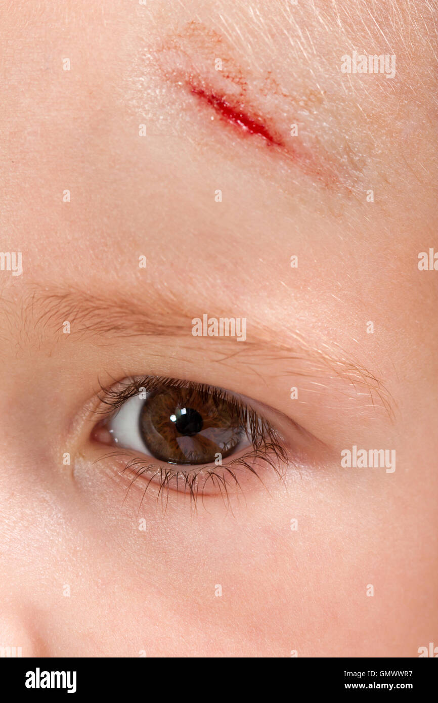 Cicatrice d'opération oeil Banque de photographies et d’images à haute ...