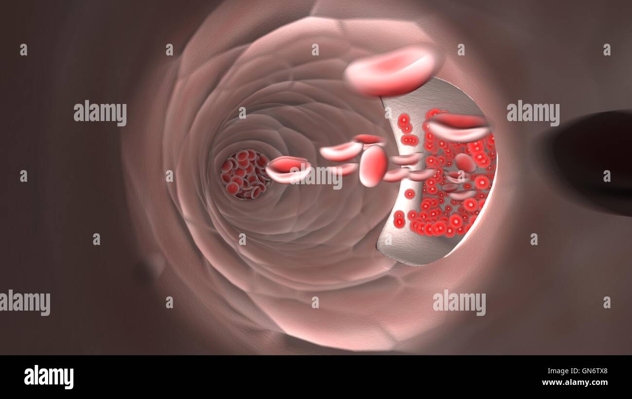 Caillot de sang dans une veine artère Banque de photographies et d ...