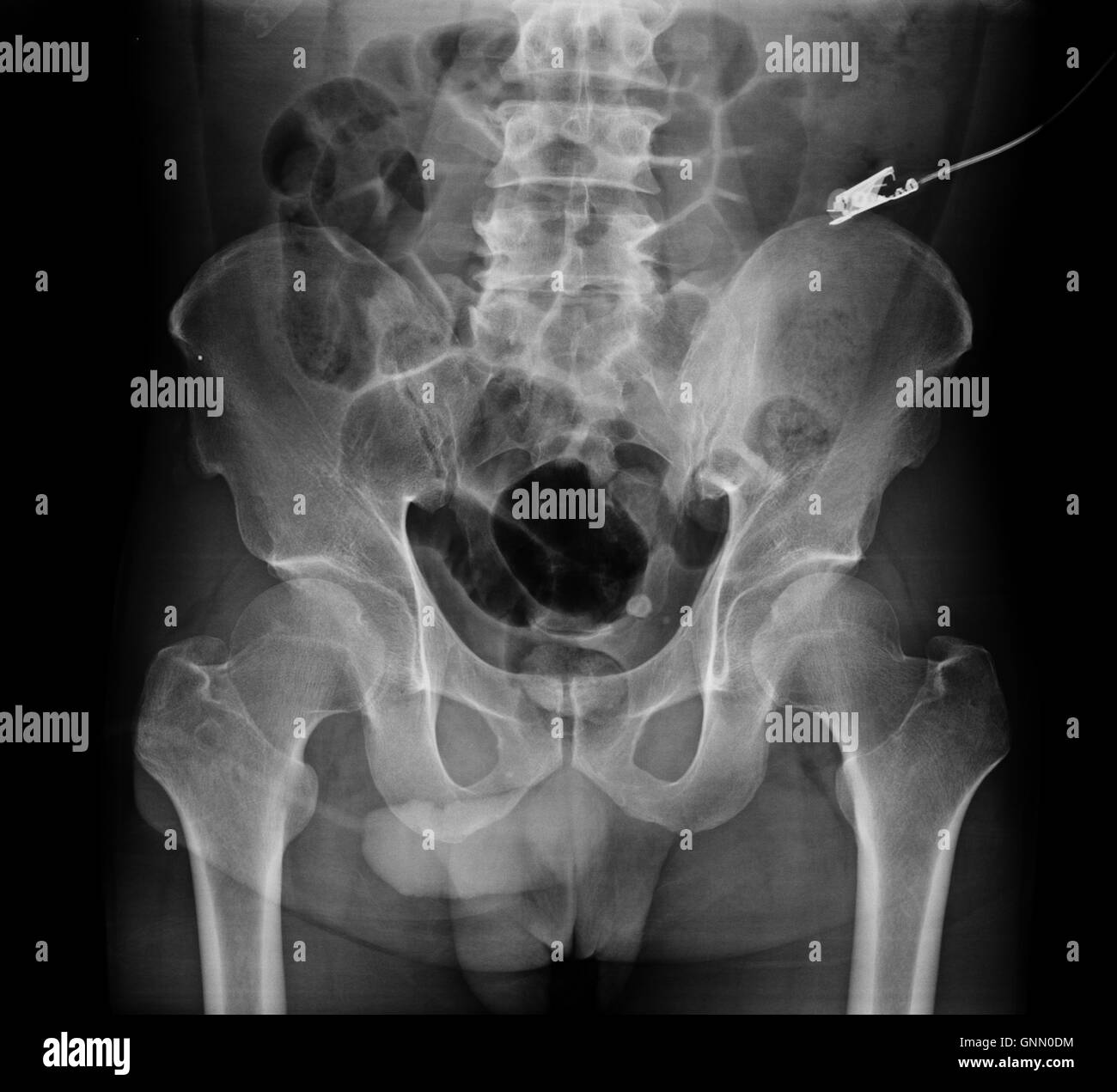 X-ray du bassin et de la colonne vertébrale Photo Stock - Alamy