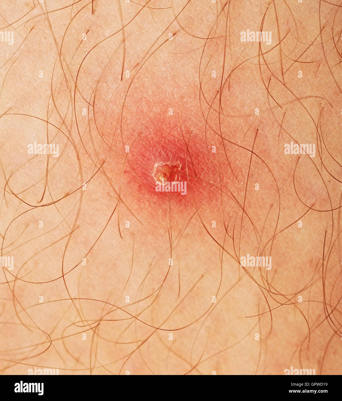 Abscess acne blemish blister boil bump Banque de photographies et d ...