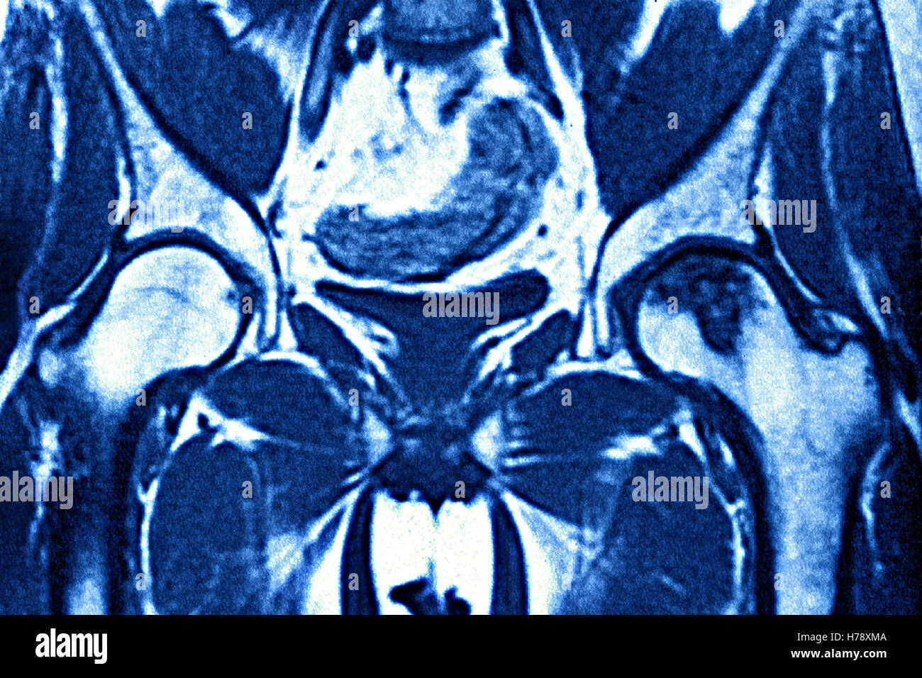 Arthrose hanche Banque de photographies et d’images à haute résolution ...