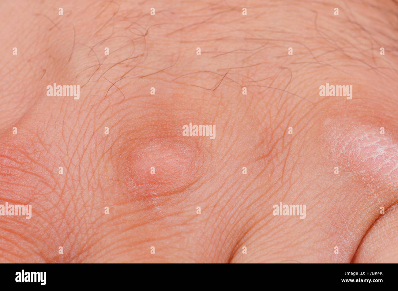 Tache rouge peau main Banque de photographies et d’images à haute ...