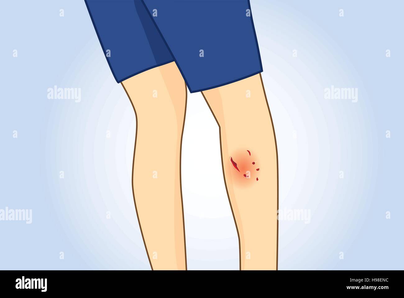 Dog bite wound Banque d'images vectorielles - Alamy