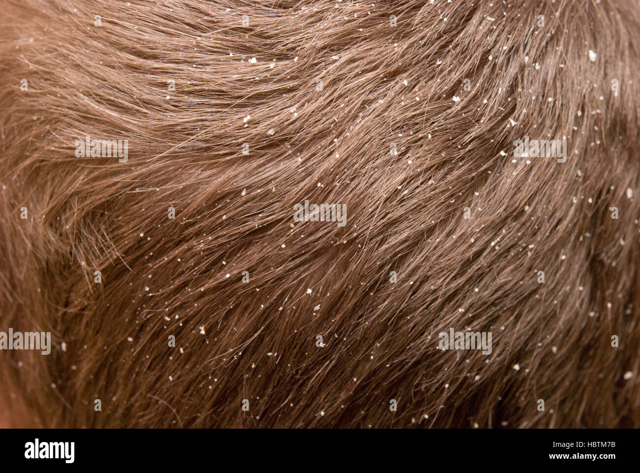 Pellicules de cheveux humains Banque de photographies et d’images à ...