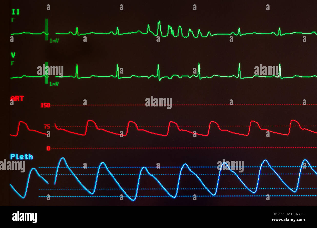 Close up de moniteur médical avec ECG avec tachycardie ventriculaire ...