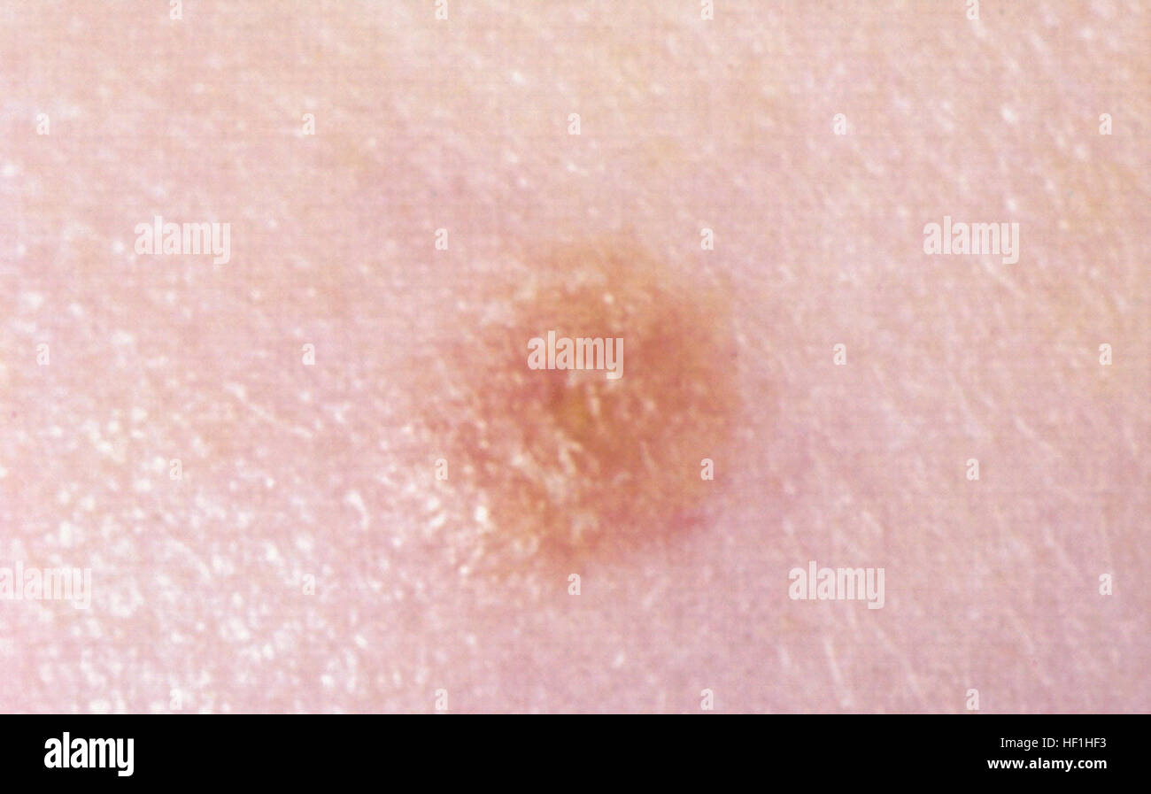Spitz nevus Banque de photographies et d’images à haute résolution - Alamy