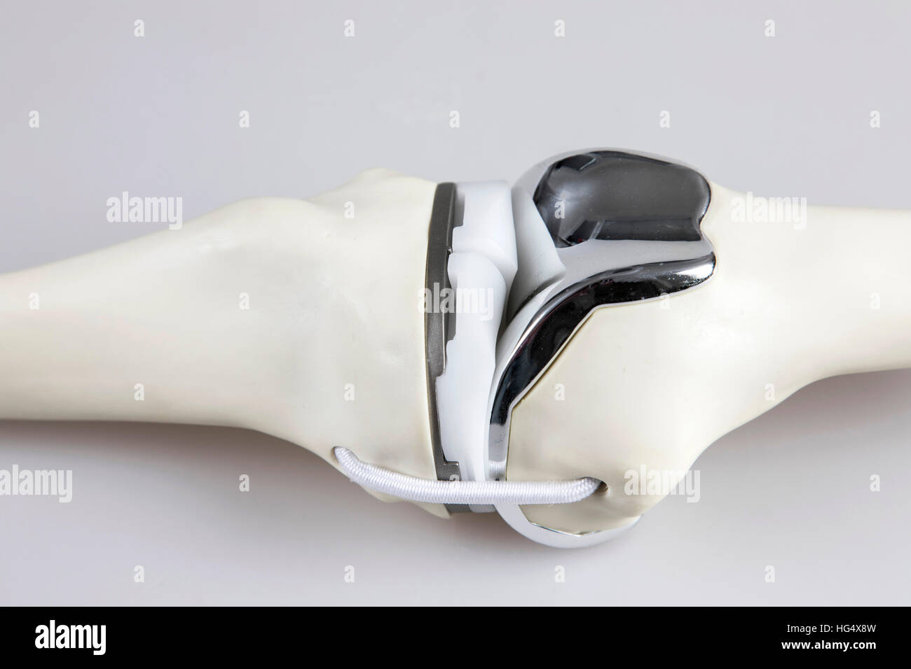 Prothèse du genou, genou endoprothèse ou du genou prothèse, sur un ...