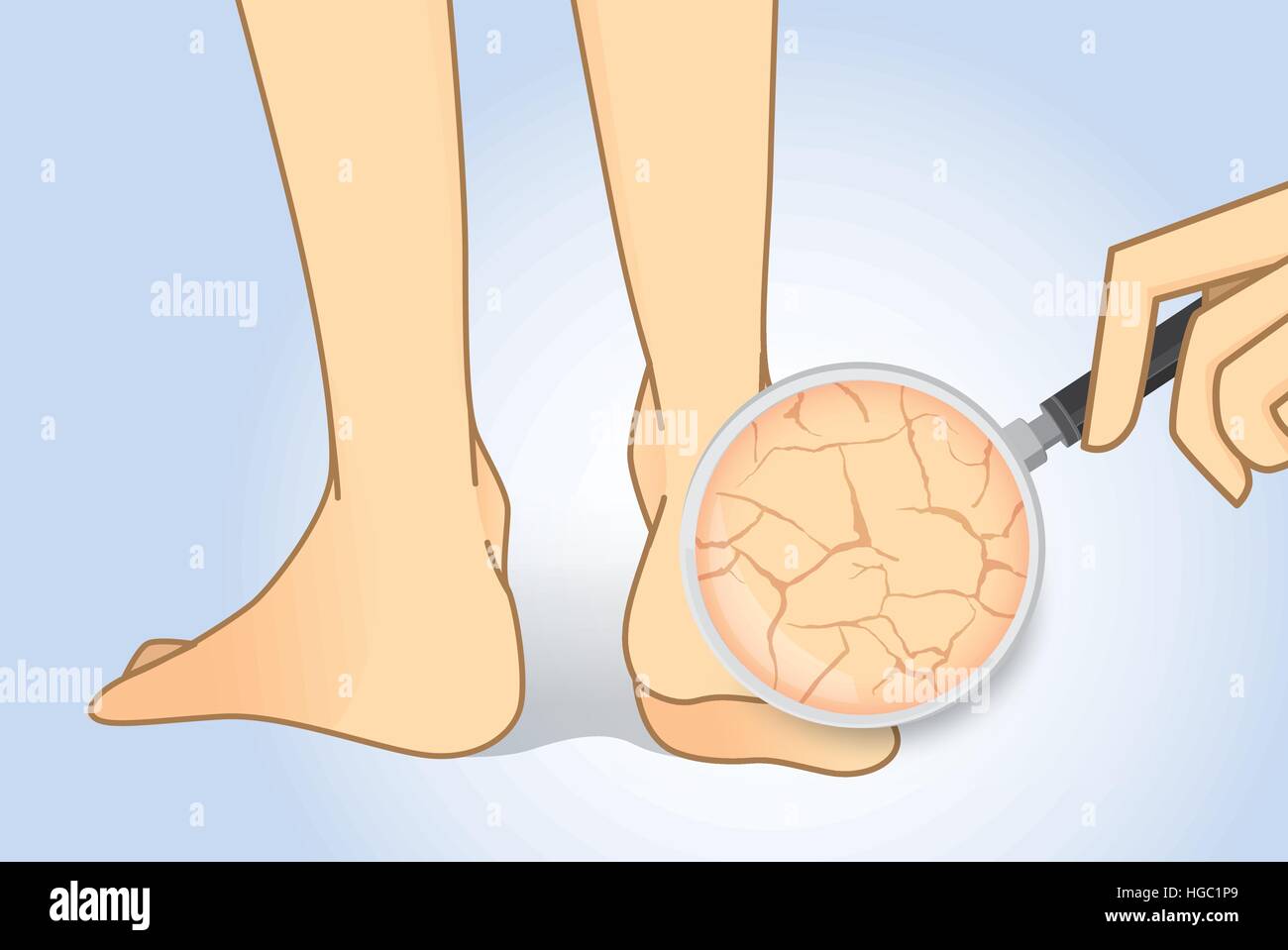 Talon fissuré Banque d'images vectorielles - Alamy