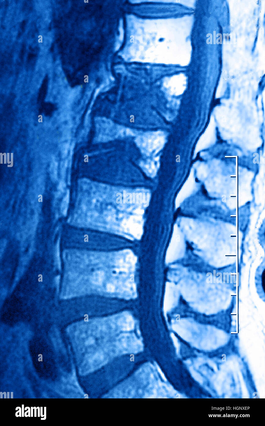 Fracture du rachis Banque de photographies et d’images à haute ...