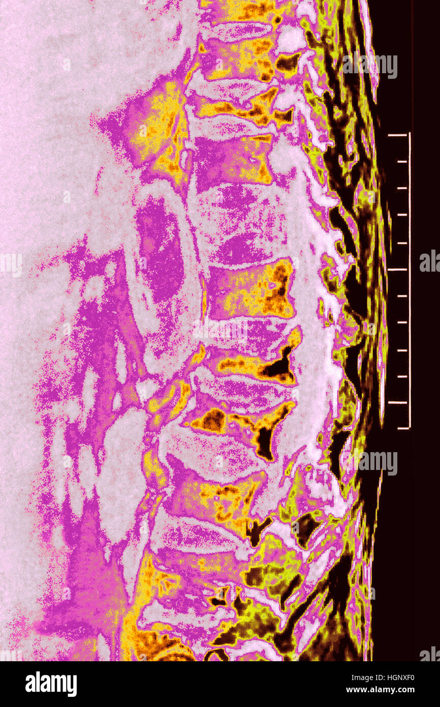 FRACTURE par tassement, IRM Photo Stock - Alamy
