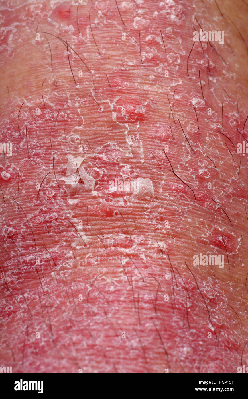 Psoriasis en plaques Banque de photographies et d’images à haute ...