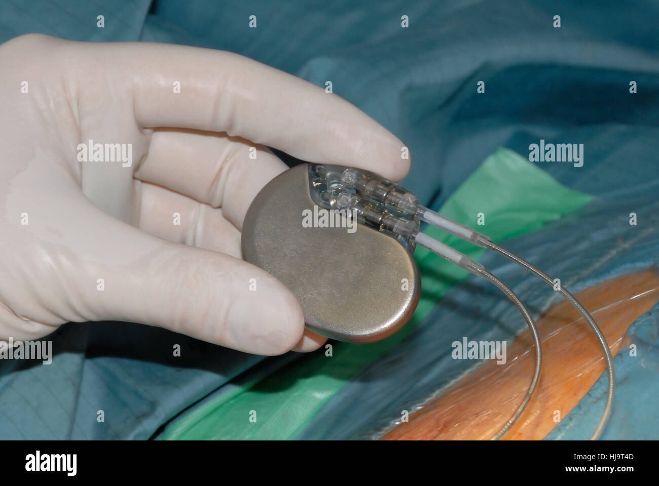 Pacemaker implantation Banque de photographies et d’images à haute ...
