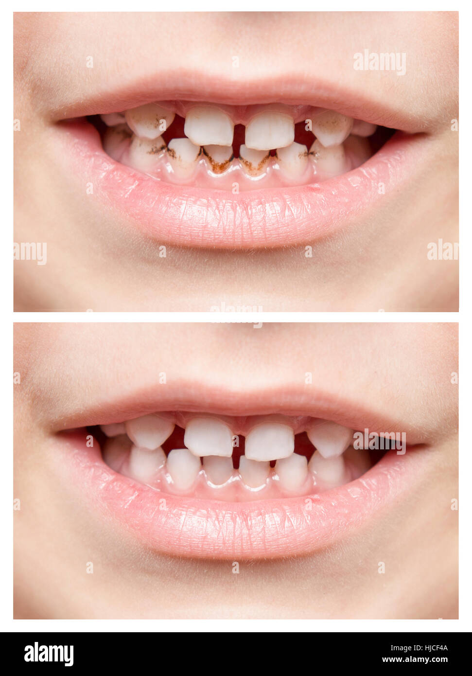 Les dents. La bouche de l'enfant. Gros plan de la photo. Collage Photo ...