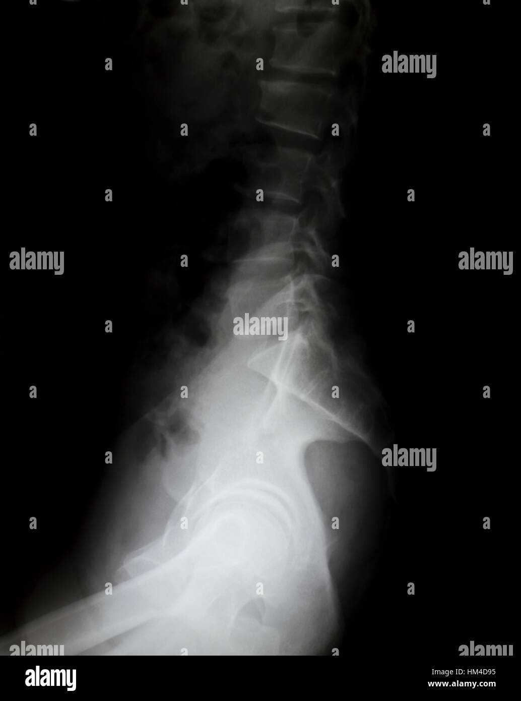 X-ray du bassin et de la colonne vertébrale Photo Stock - Alamy