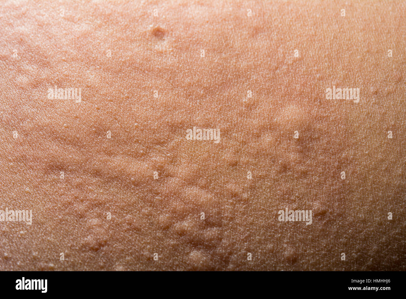 Réaction inflammatoire Banque de photographies et d’images à haute ...