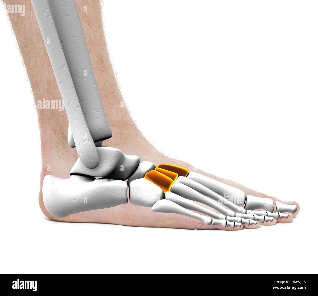 Calcaneus fracture Banque de photographies et d’images à haute ...