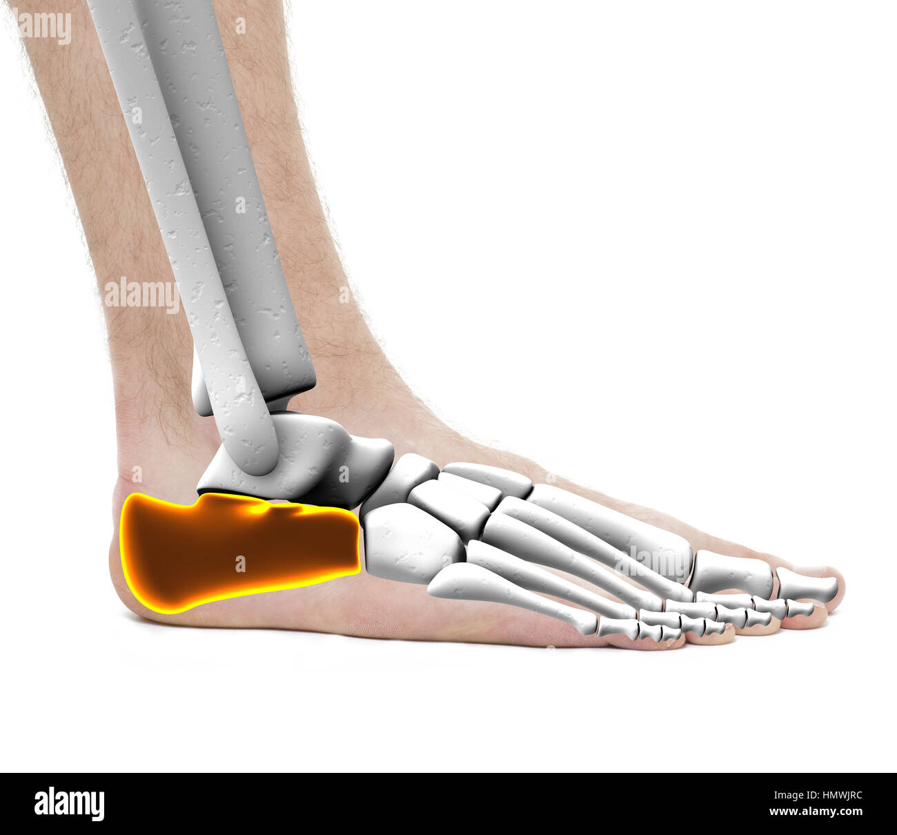 Fracture du talon Banque de photographies et d’images à haute ...