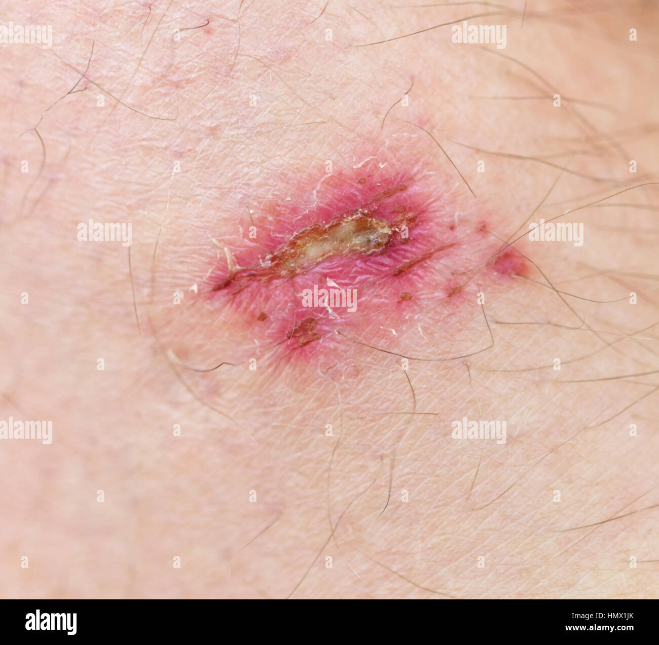 Blessure à la jambe infectée Banque de photographies et d’images à ...