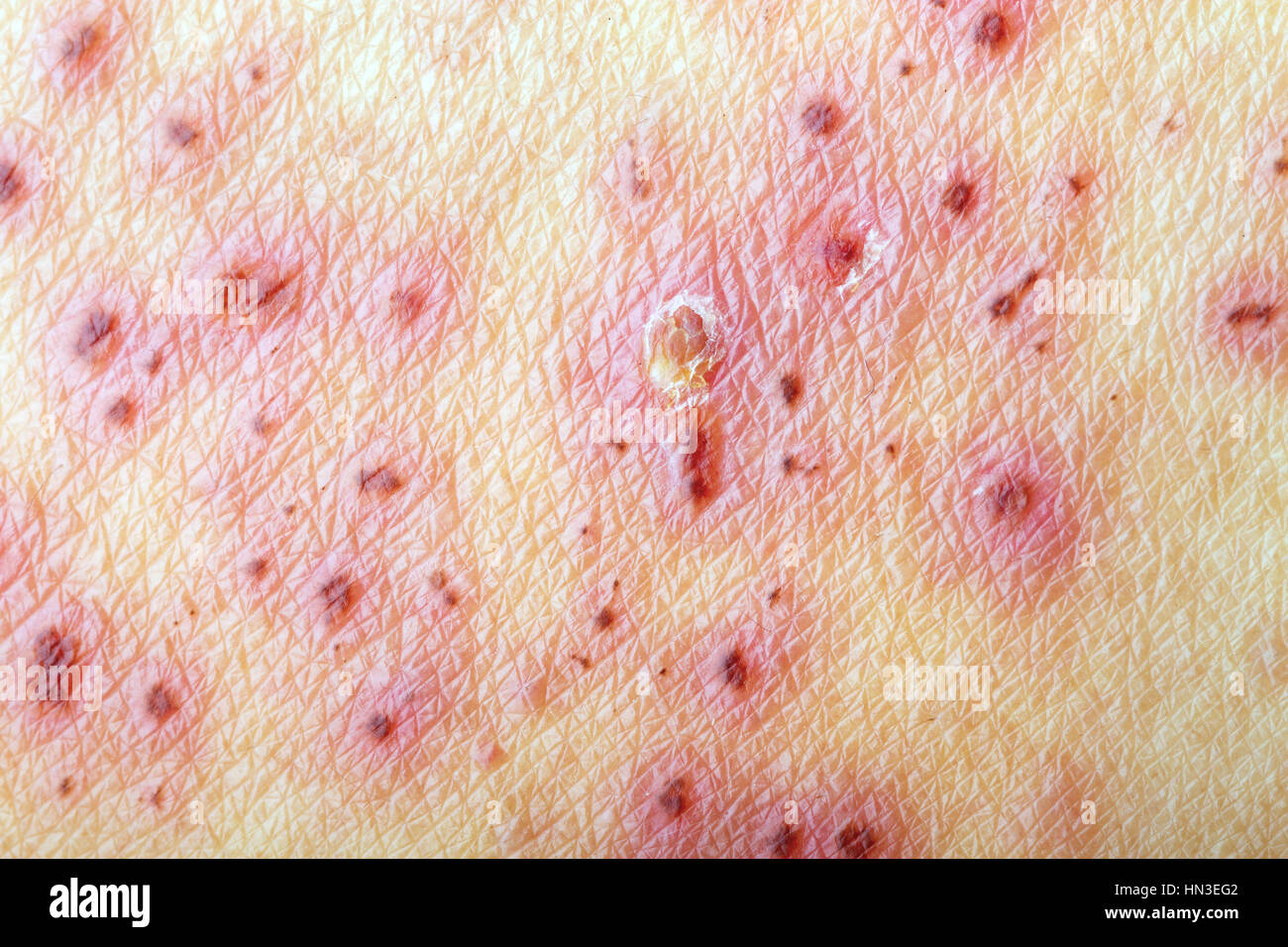 Varicella zoster herpes Banque de photographies et d’images à haute ...