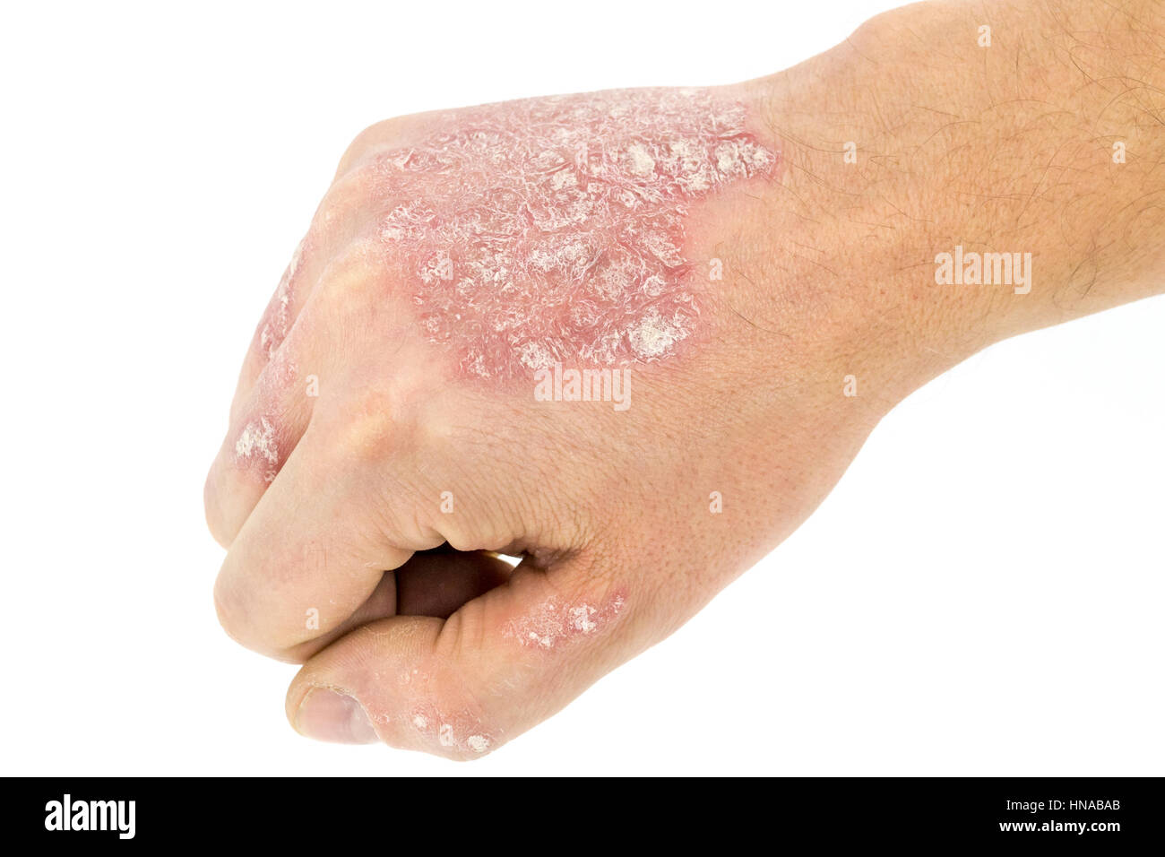 éruption cutanée sur les mains Banque de photographies et d’images à ...
