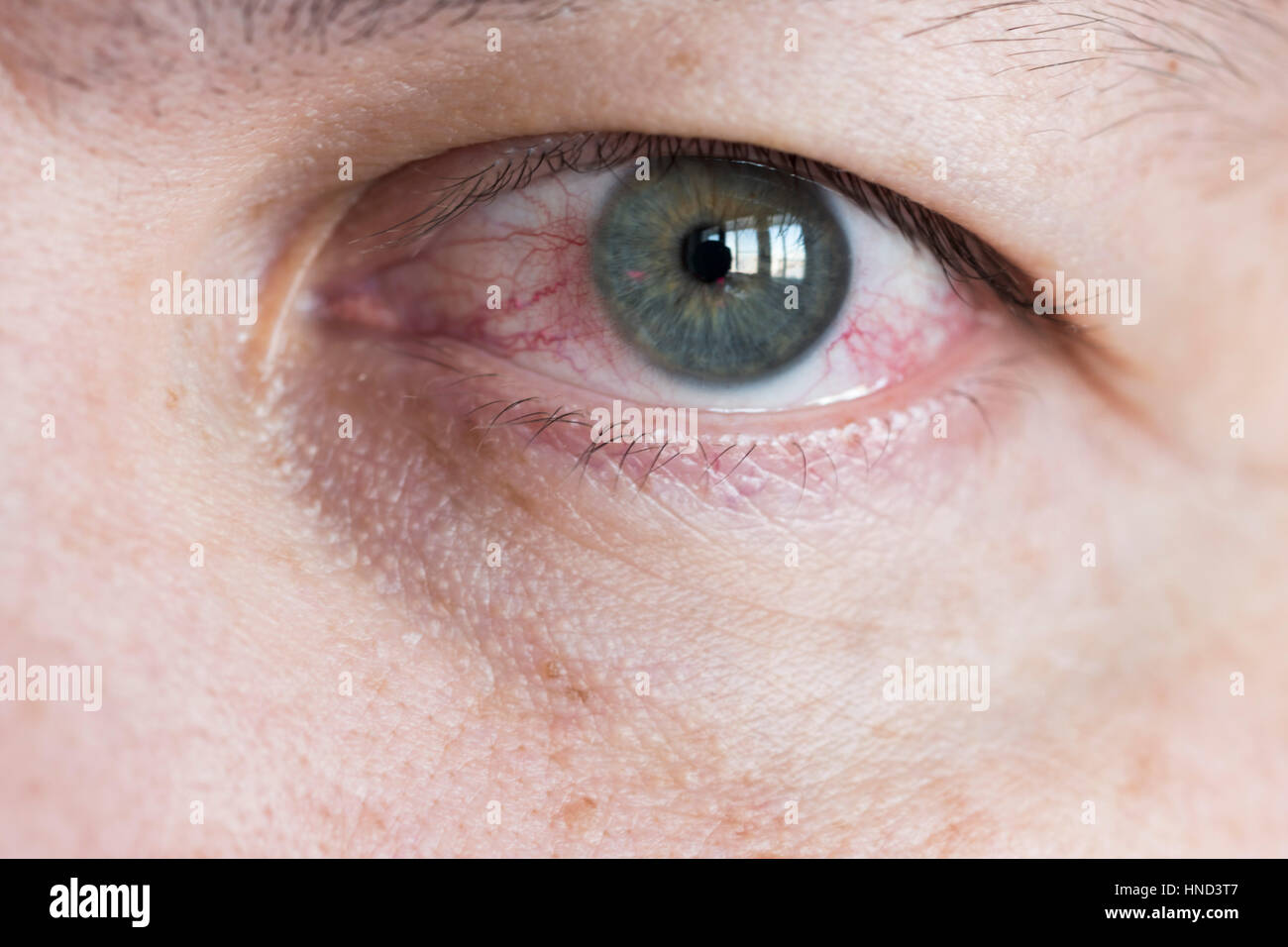 Allergie Au Pollen Yeux Banque d'image et photos - Alamy