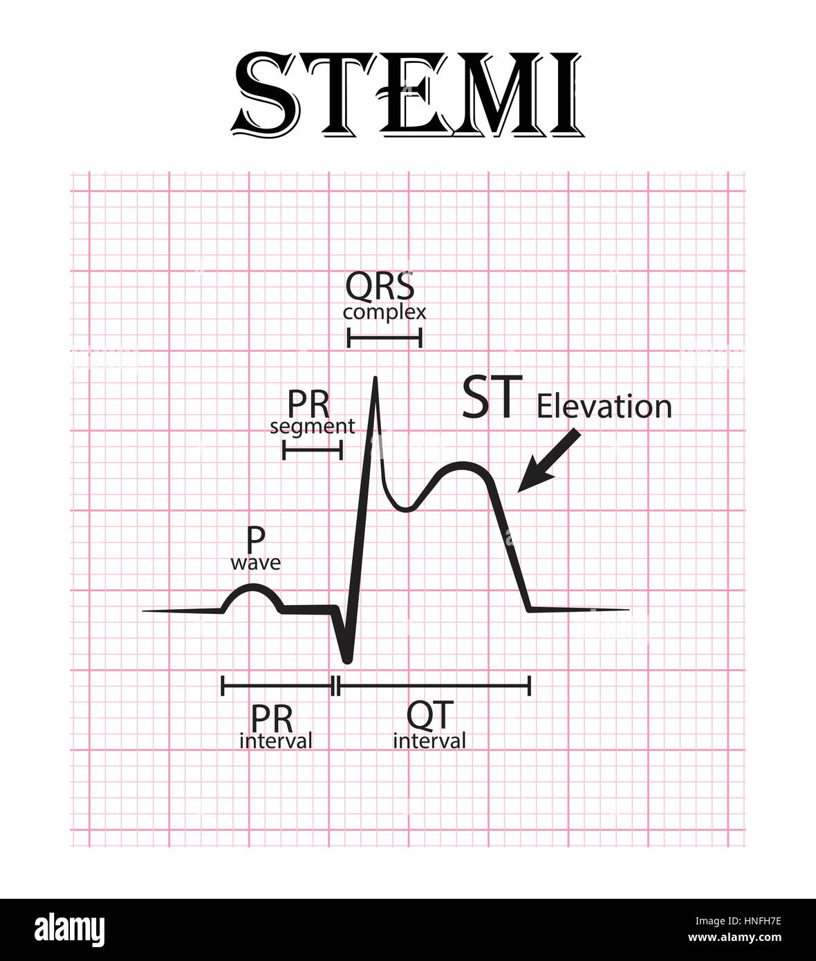 L'ECG de l'infarctus du myocarde ST STEMI ( ) et le détail de l'ECG ( P ...
