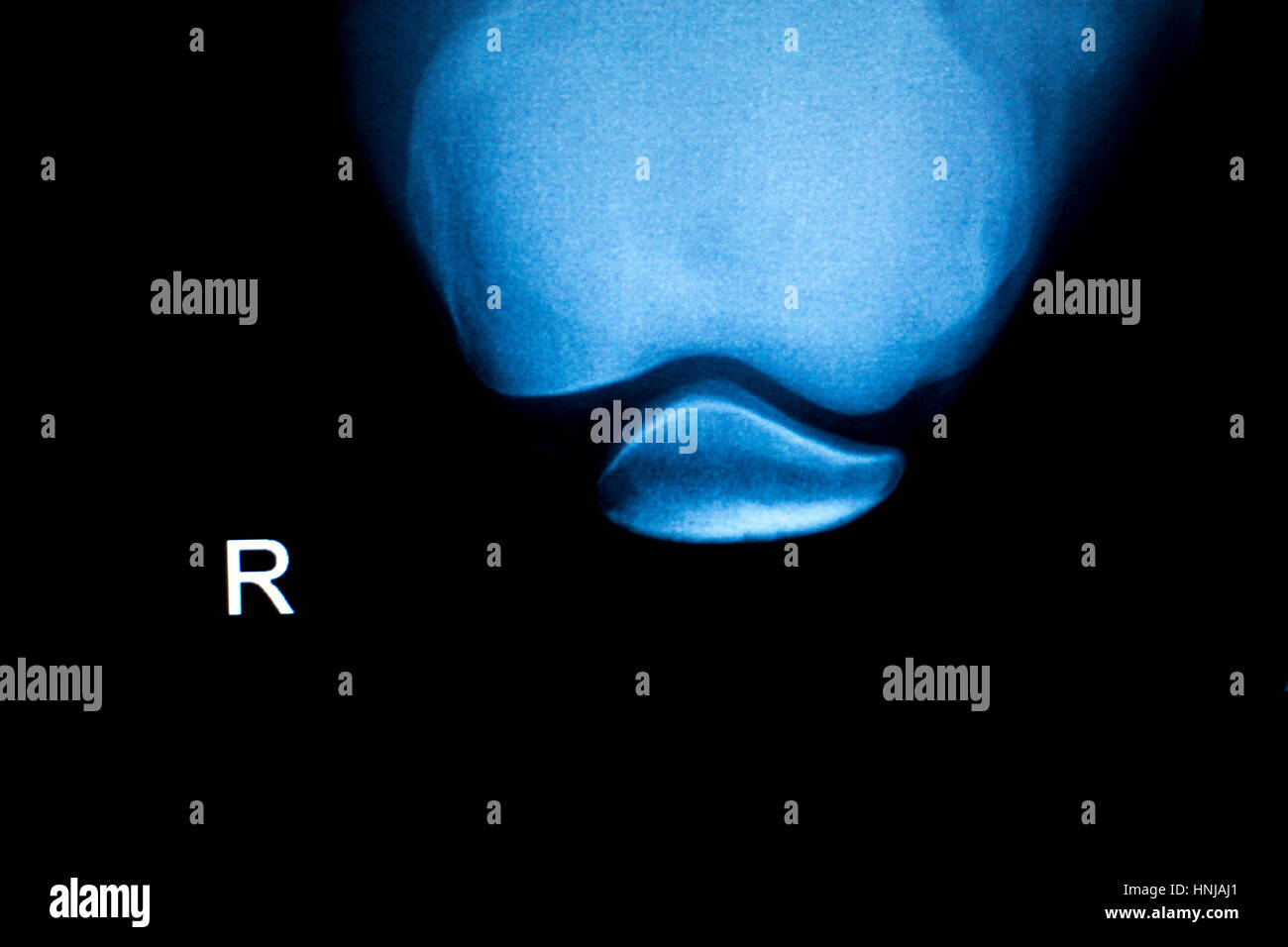 Orthopédie genou ménisque, ligaments, tendons et cartilages blessures ...