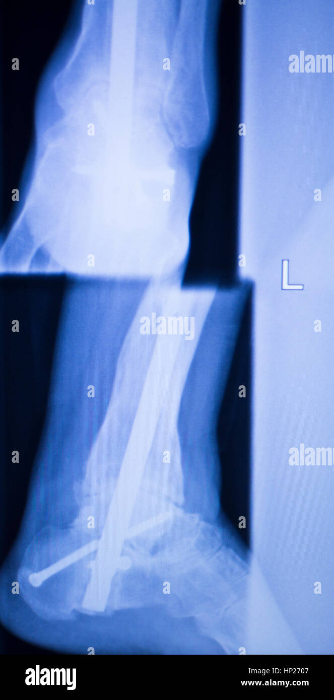 Talon cheville radiographie traumatologie Banque de photographies et d ...