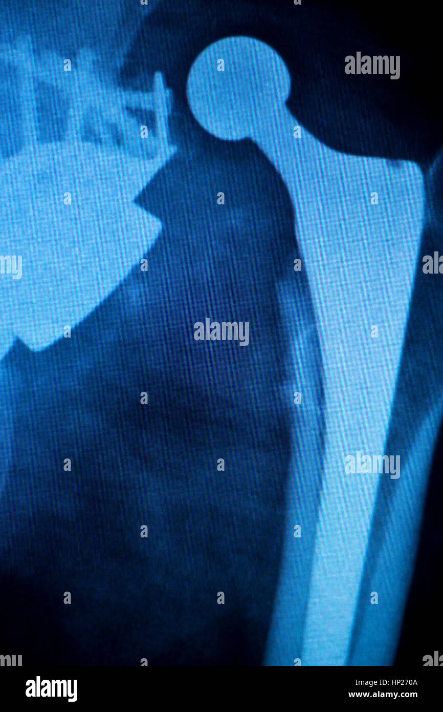 Articulation de la hanche usée Banque de photographies et d’images à ...