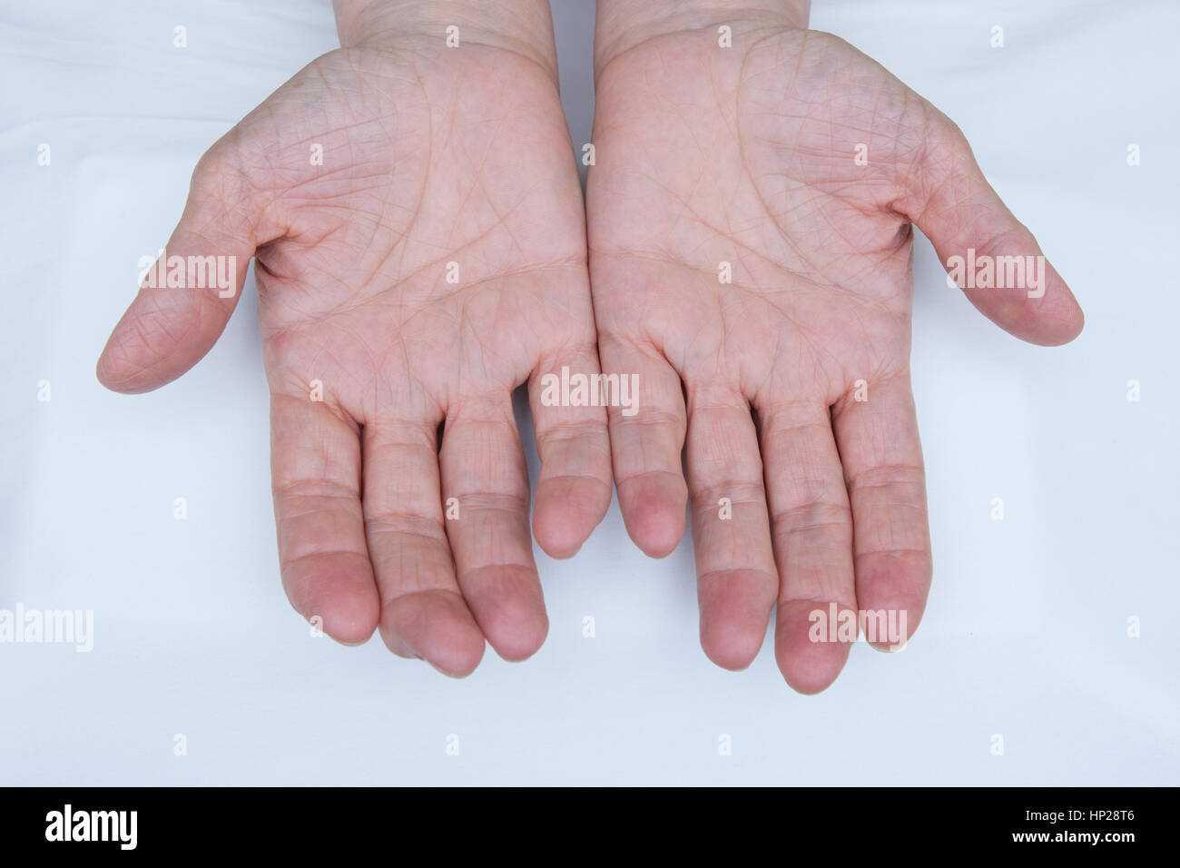 L'arthrose des mains et des doigts d'une femme Photo Stock - Alamy